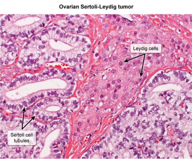 Sertoli-Leydig cell tumor | 자유게 | 캐시피드